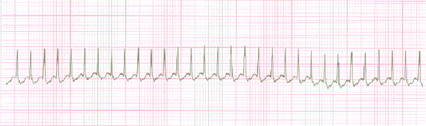 Supraventricular Tachycardia | Spot Diagnosis | Pediatric Oncall