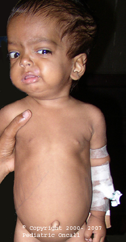 Osteopetrosis | Spot Diagnosis | Pediatric Oncall