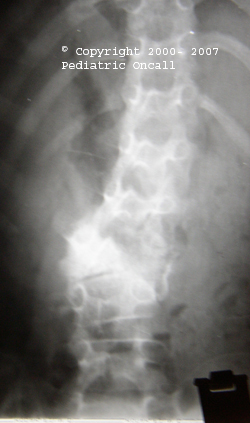 Pott`s Spine | Spot Diagnosis | Pediatric Oncall