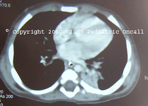 Bronchogenic Cyst | Spot Diagnosis | Pediatric Oncall