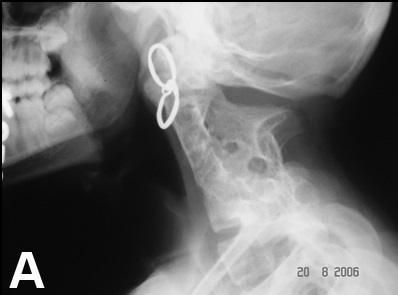 Klippel-feil Anomaly | Spot Diagnosis | Pediatric Oncall