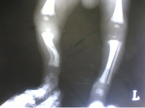 Tibia Deformity | Spot Diagnosis | Pediatric Oncall