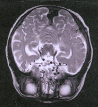 Congenital Cytomegalovirus Infection | Spot Diagnosis | Pediatric Oncall