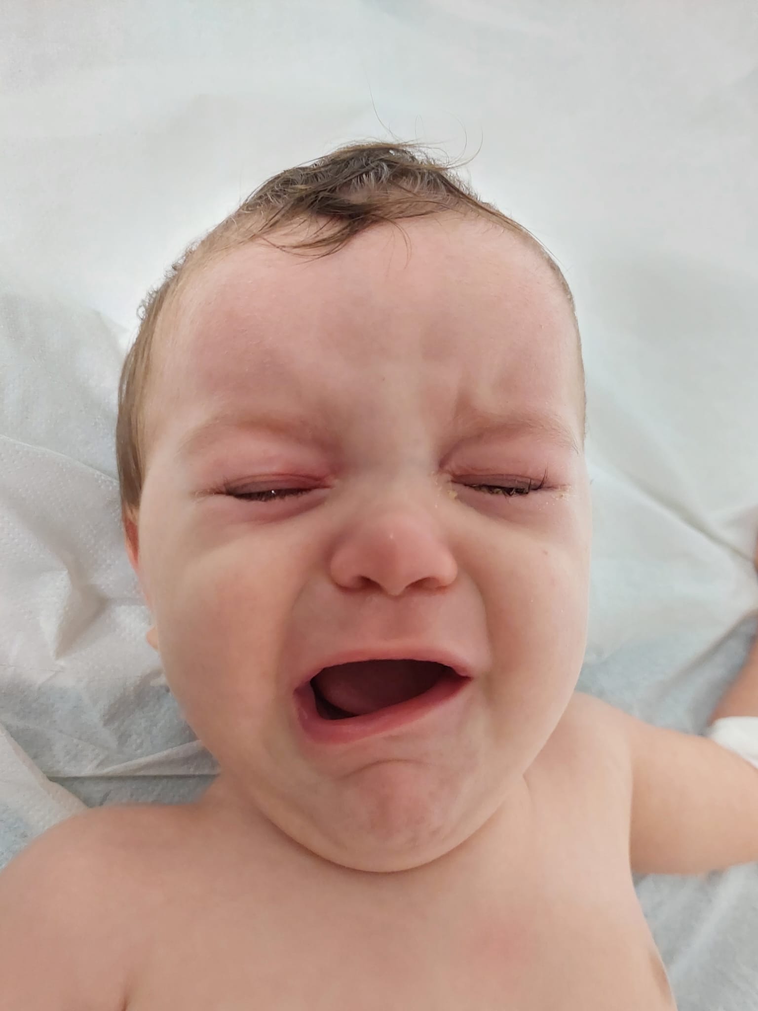 Figure 1. Facial asymmetry observed when crying with the right side of ...