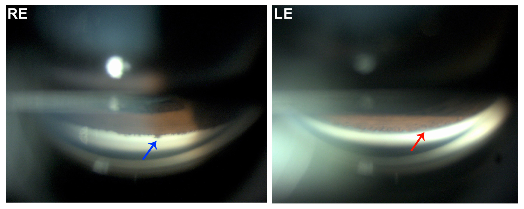 Persistent pupillary membrane and secondary angle closure glaucoma: a ...