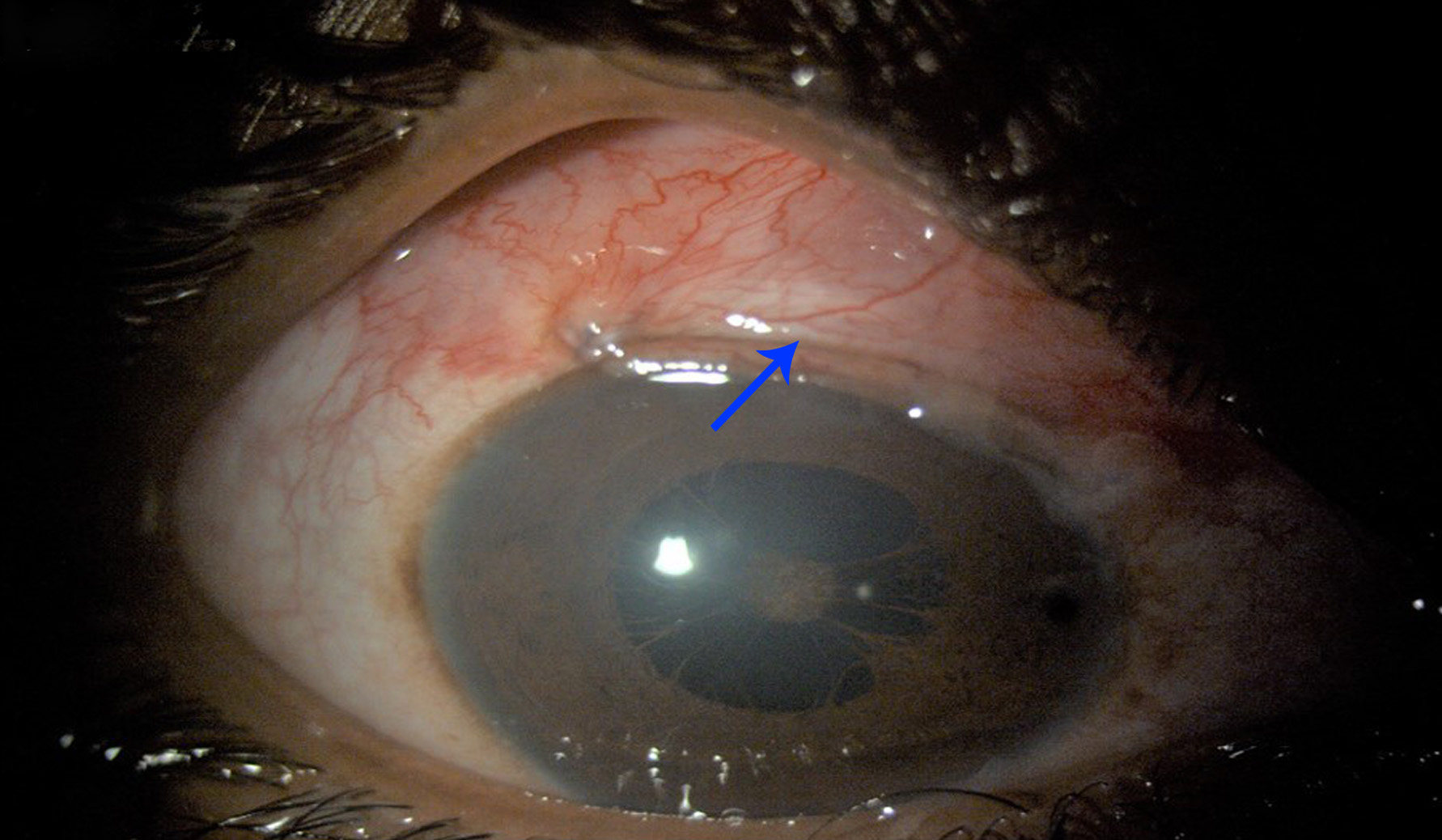 Persistent pupillary membrane and secondary angle closure glaucoma: a ...