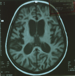 Hiv Encephalopathy | Spot Diagnosis | Pediatric Oncall