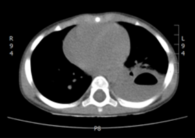 Lung abscess - the answer is in the chest radiograph | Pediatric Oncall ...