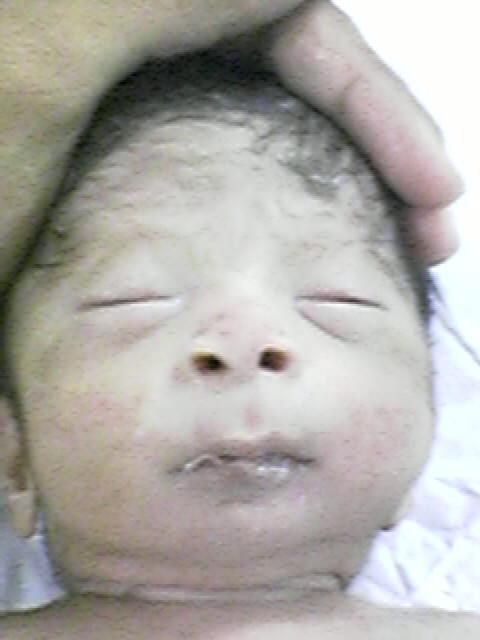 Smith-lemli opitz syndrome | Pediatric Oncall Journal