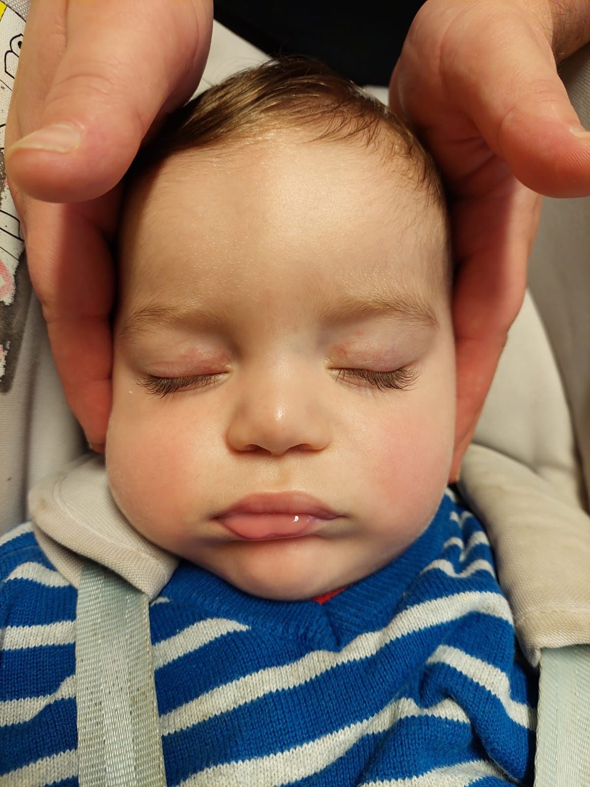 Figure 2. Symmetrical facial expression at rest with only the left ...