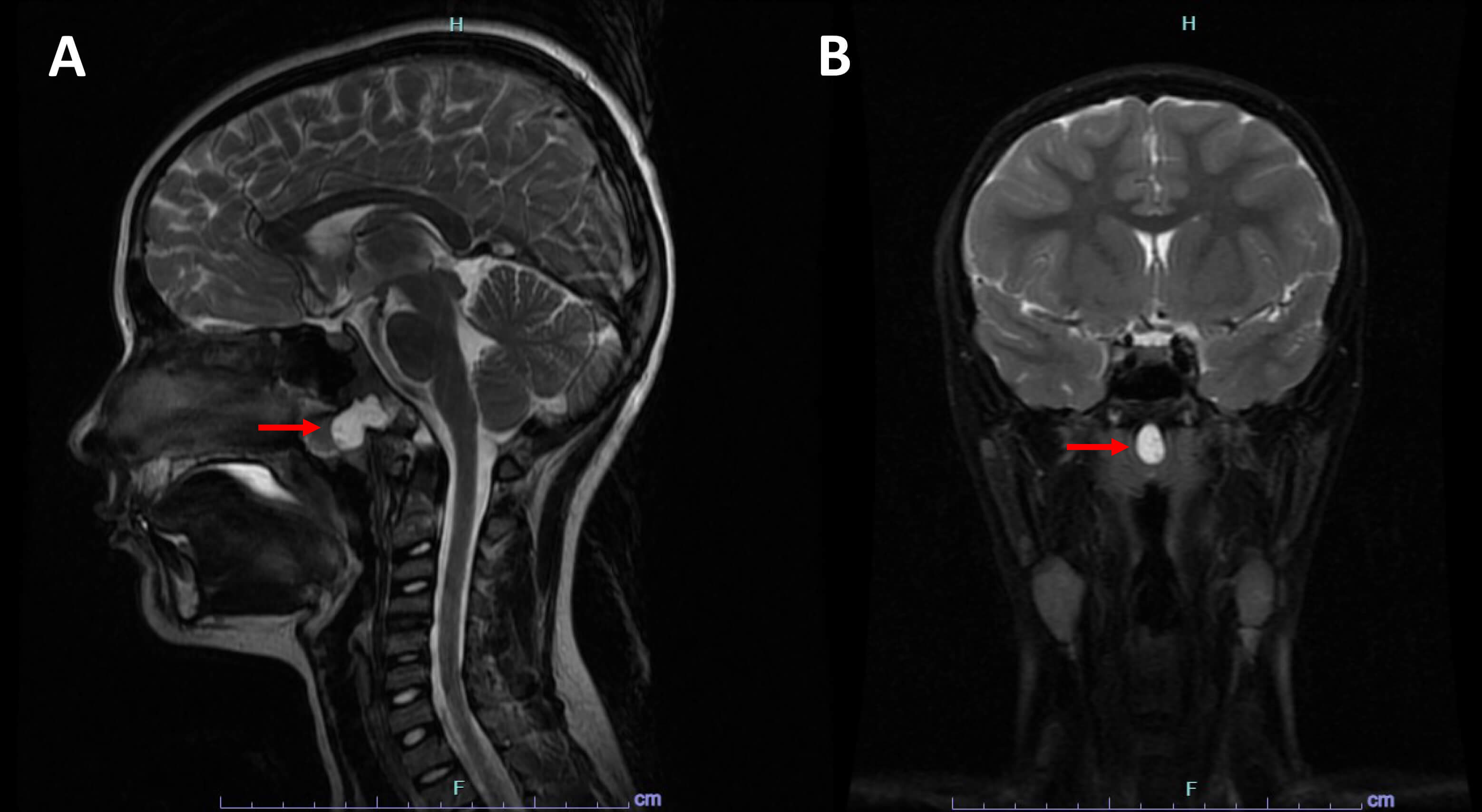 Tornwaldt's cyst - an unusual diagnosis with an atypical form of ...