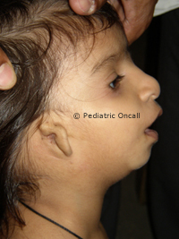 Treacher Collins Syndrome | Spot Diagnosis | Pediatric Oncall