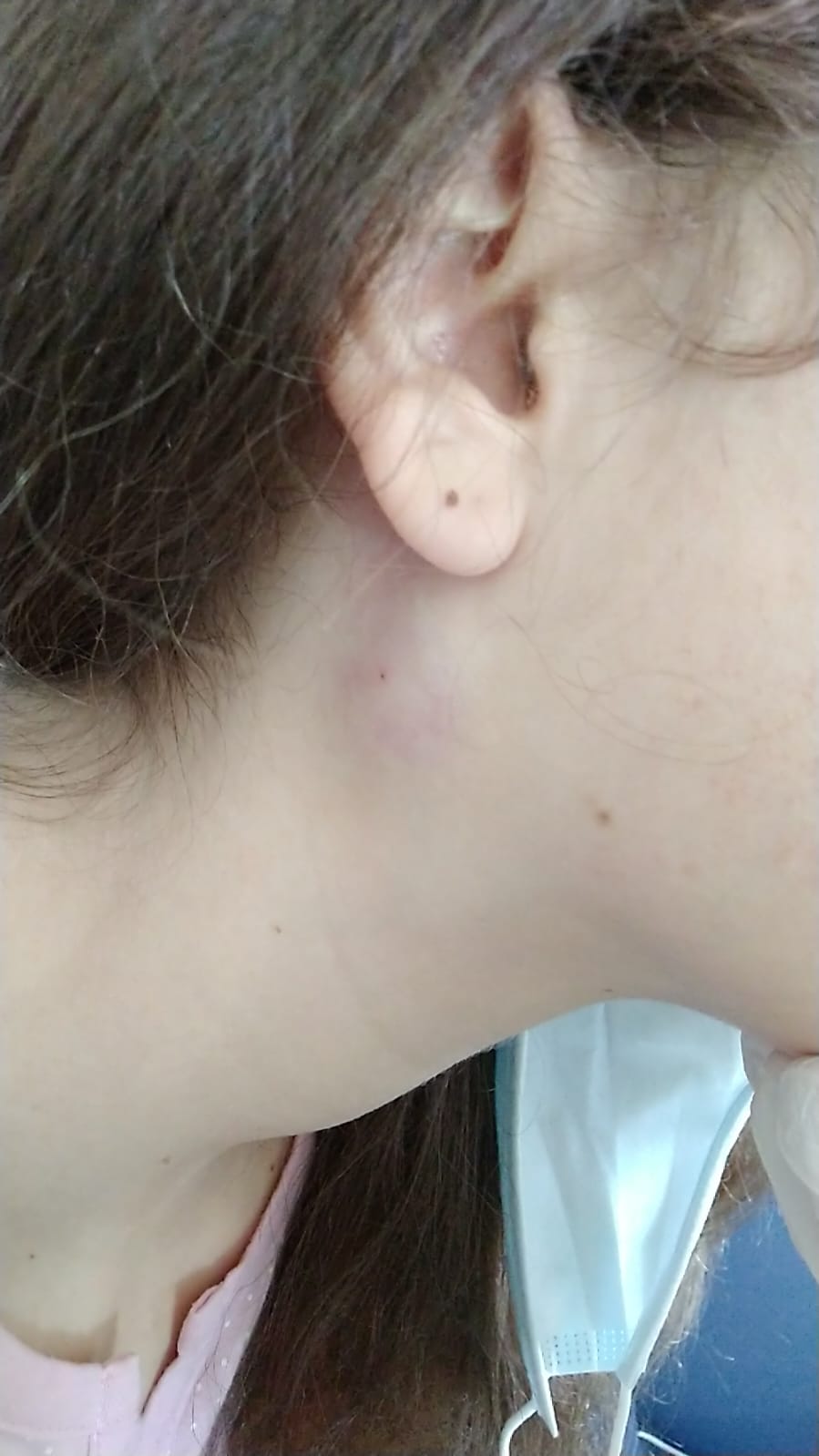 Figure 2. Tumefactions inflammatory signs on the first day of ...