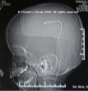 Vp Shunt | Spot Diagnosis | Pediatric Oncall