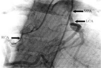 Anomalous origin of the left main coronary artery (alcapa) syndrome ...