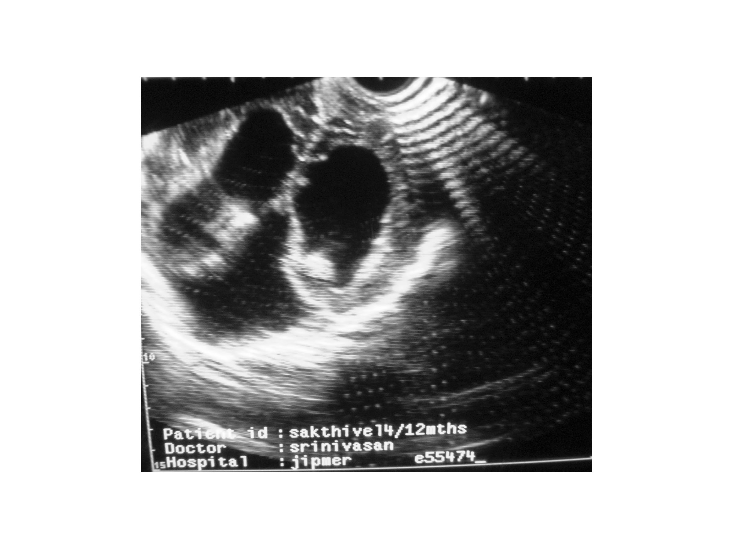 Dandy Walker Ultrasound