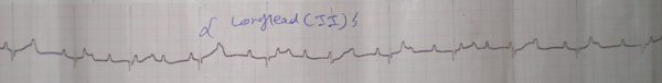 Complete Heart Block | Spot Diagnosis | Pediatric Oncall
