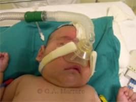 Practical guidelines for mechanical ventilation | Pediatric Oncall Journal