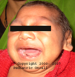 Microcephaly | Spot Diagnosis | Pediatric Oncall