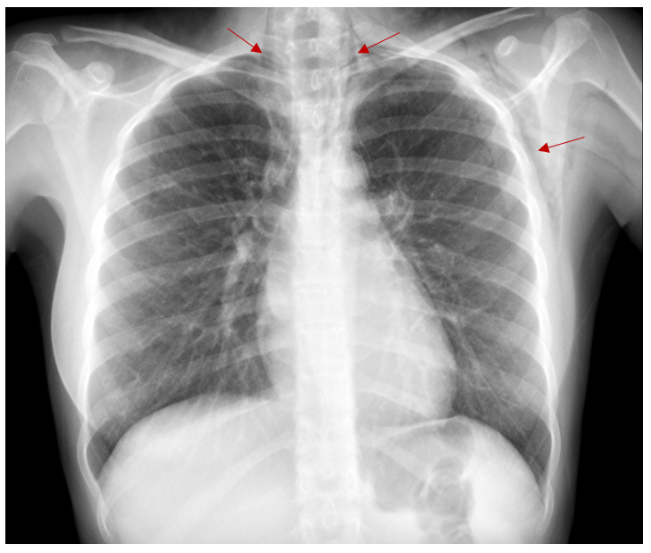 Figure 1. Chest X-ray revealing pneumomediastinum and bilateral ...