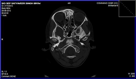 Recurrent meningitis in a child | Pediatric Oncall Journal