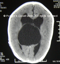 Ventricular Cyst | Spot Diagnosis | Pediatric Oncall