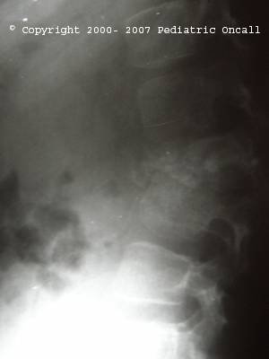 Vertebral Collapse Or Compression Fracture Of Vertebra | Spot Diagnosis ...