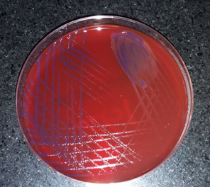 Chromobacterium violaceum bacteremia in a 2 years old male child ...