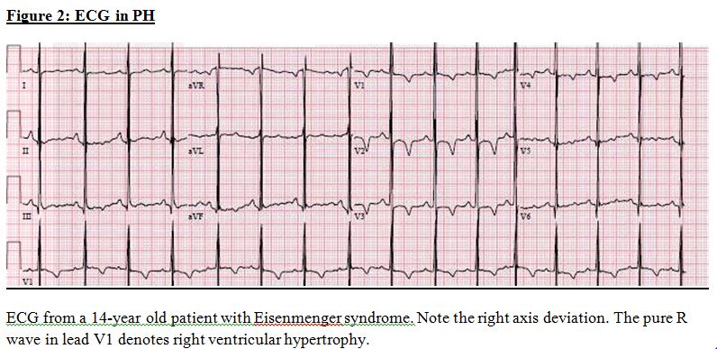 Pediatric Cardiology : Pulmonary Hypertension : Pulmonary Hypertension ...