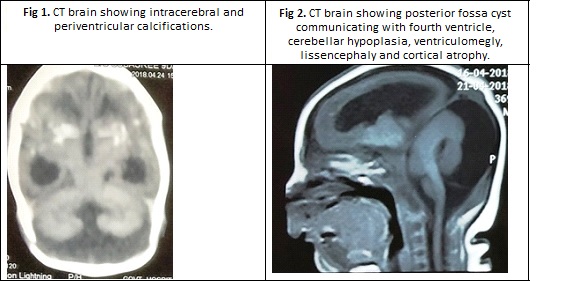 Intracranial calcifications with dandy walker malformation | Pediatric ...