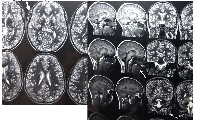 Platelet Transfusion: Diseases and Conditions | Pediatric Oncall