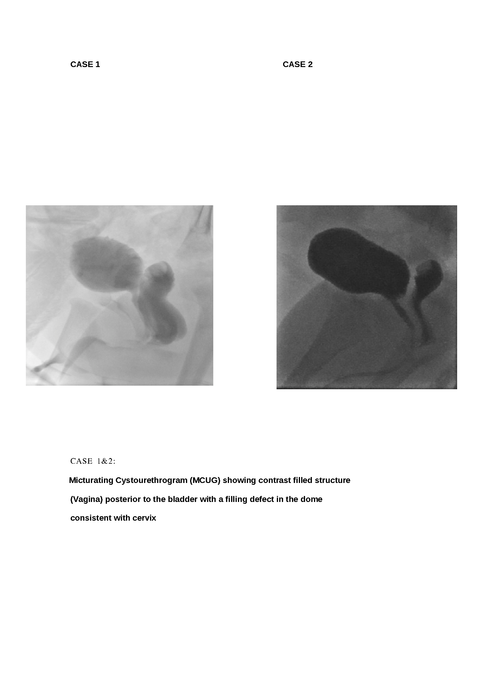 Micturating Cystourethrogram {mcug} In 2 Female Infants– What Is The ...