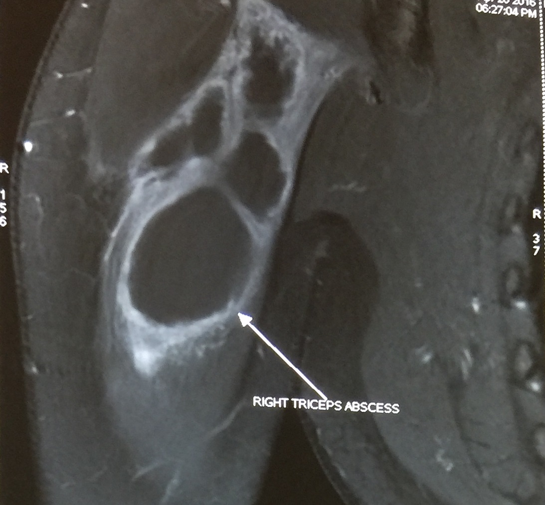Musculoskeletal Cysticercosis | Grand Rounds | Pediatric Oncall