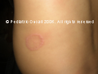 Tinea Corporis | Spot Diagnosis | Pediatric Oncall