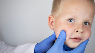 Alternative Medicine : Rubella : Rubella : Diseases and Conditions ...